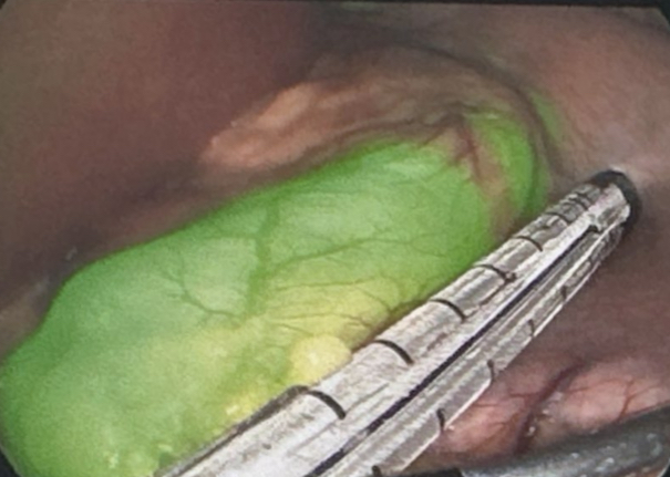 How Much Stomach Do You Remove During Gastric Sleeve Surgery?